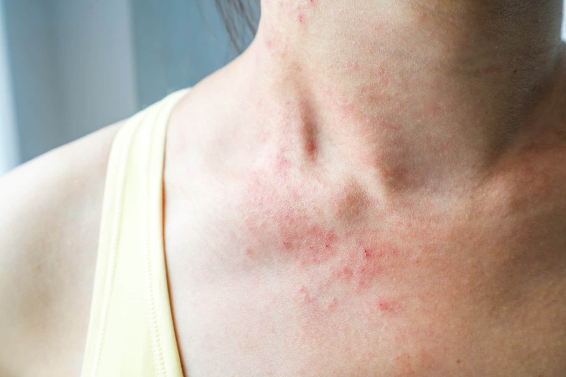 How To Avoid Keto Rash | Keto India | Healthcare And Lifestyle